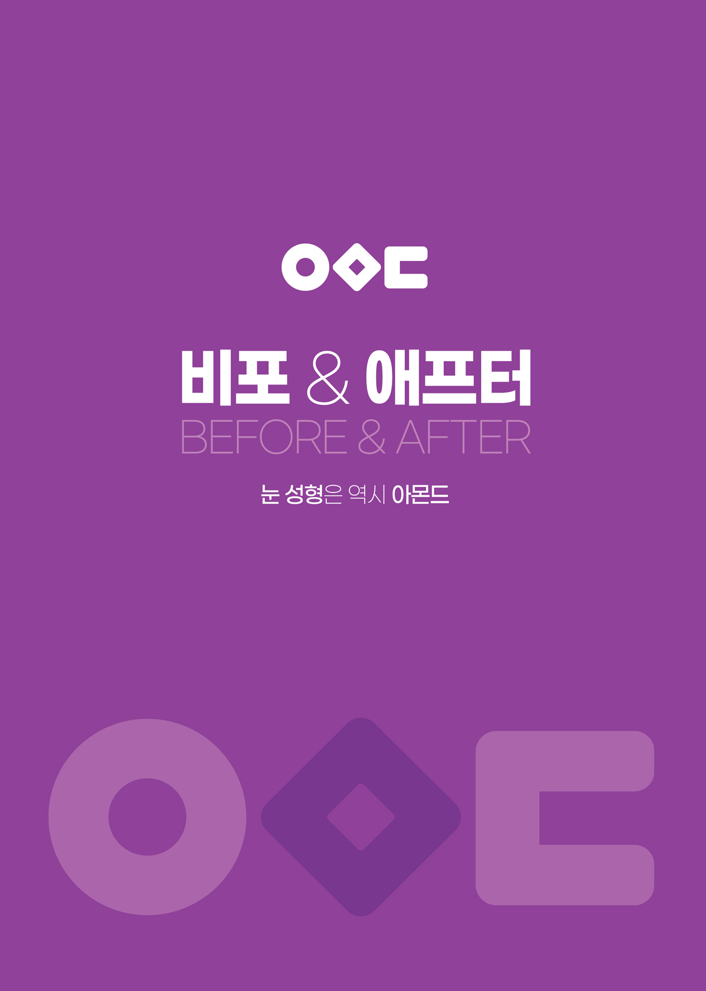 아몬드성형외과 눈밑지방재배치 안검하수 눈매교정 쌍꺼풀 쌍꺼풀수술 쌍수 자연유착쌍꺼풀 앞트임 안검하수수술 눈매교정수술전후 쌍꺼풀재수술