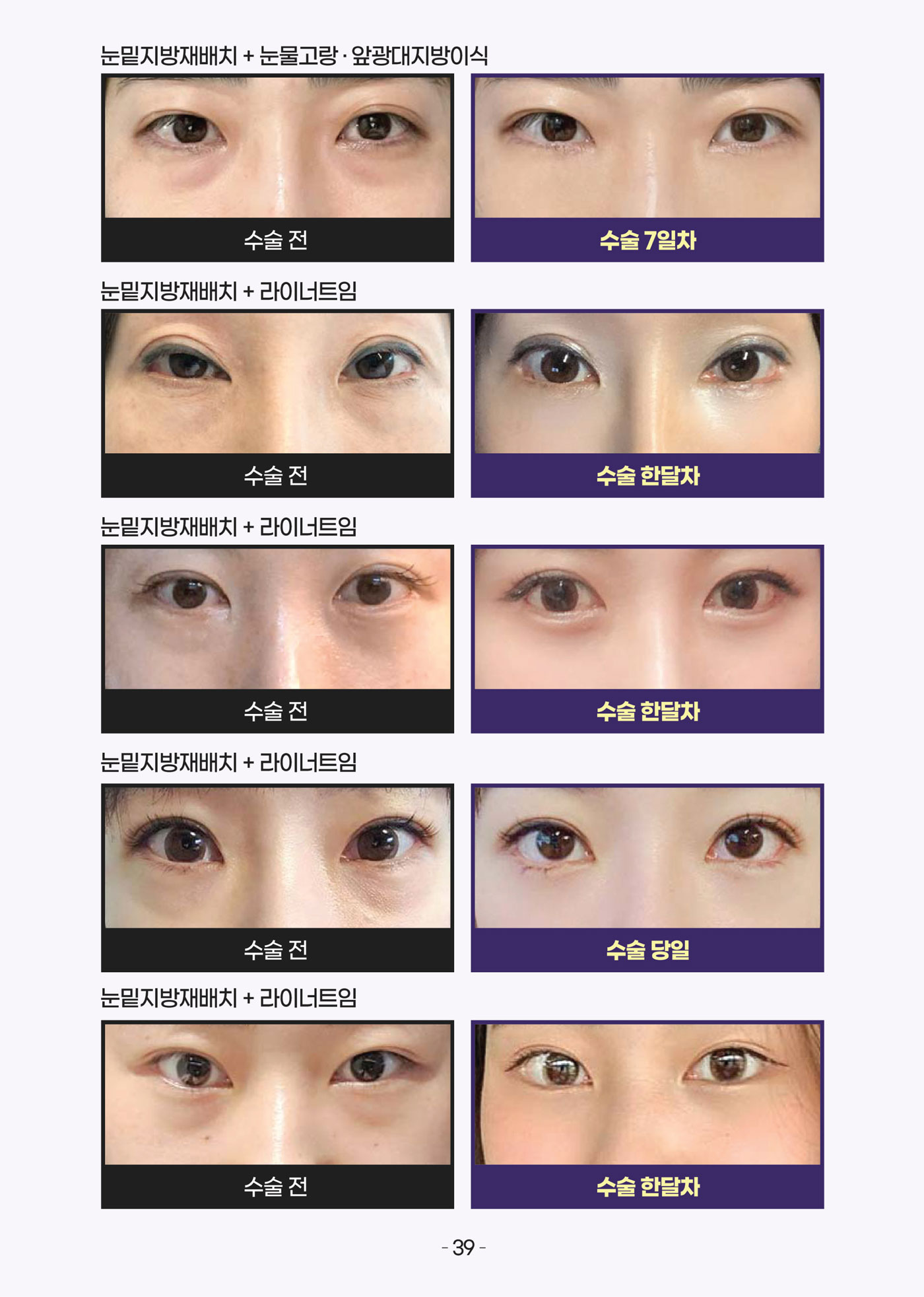 아몬드성형외과 눈밑지방재배치 안검하수 눈매교정 쌍꺼풀 쌍꺼풀수술 쌍수 자연유착쌍꺼풀 앞트임 안검하수수술 눈매교정수술전후 쌍꺼풀재수술