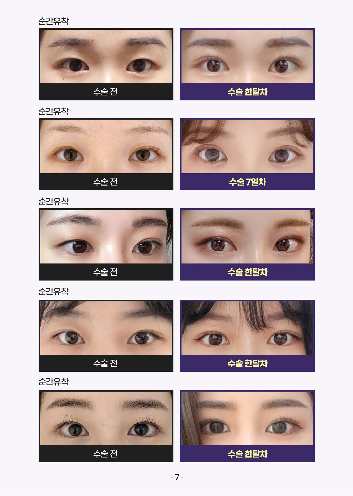 아몬드성형외과 눈밑지방재배치 안검하수 눈매교정 쌍꺼풀 쌍꺼풀수술 쌍수 자연유착쌍꺼풀 앞트임 안검하수수술 눈매교정수술전후 쌍꺼풀재수술